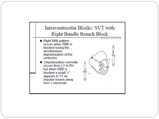 supraventricular tachycardia (SVT) with aberrancy | PPT