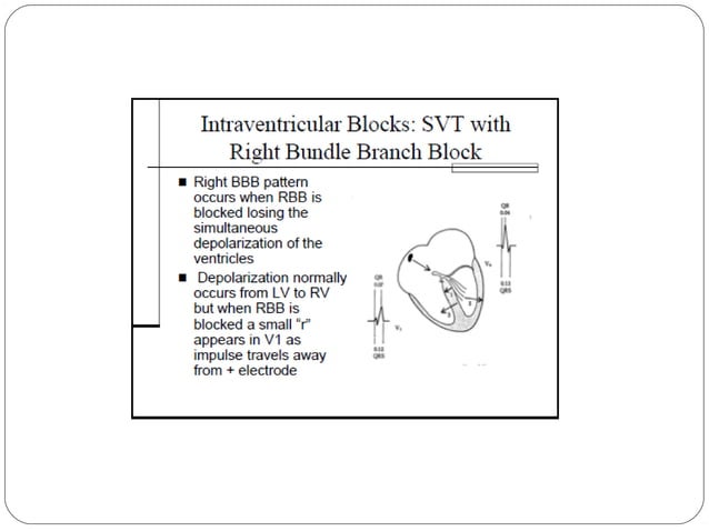 supraventricular tachycardia (SVT) with aberrancy | PPT