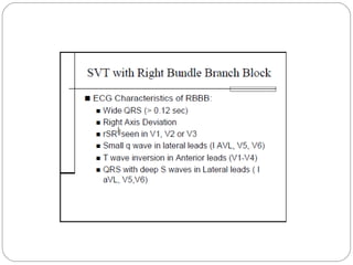 supraventricular tachycardia (SVT) with aberrancy | PPT