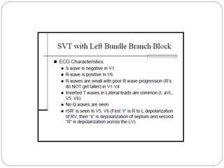 supraventricular tachycardia (SVT) with aberrancy | PPT