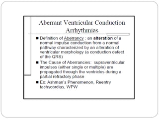 supraventricular tachycardia (SVT) with aberrancy | PPT