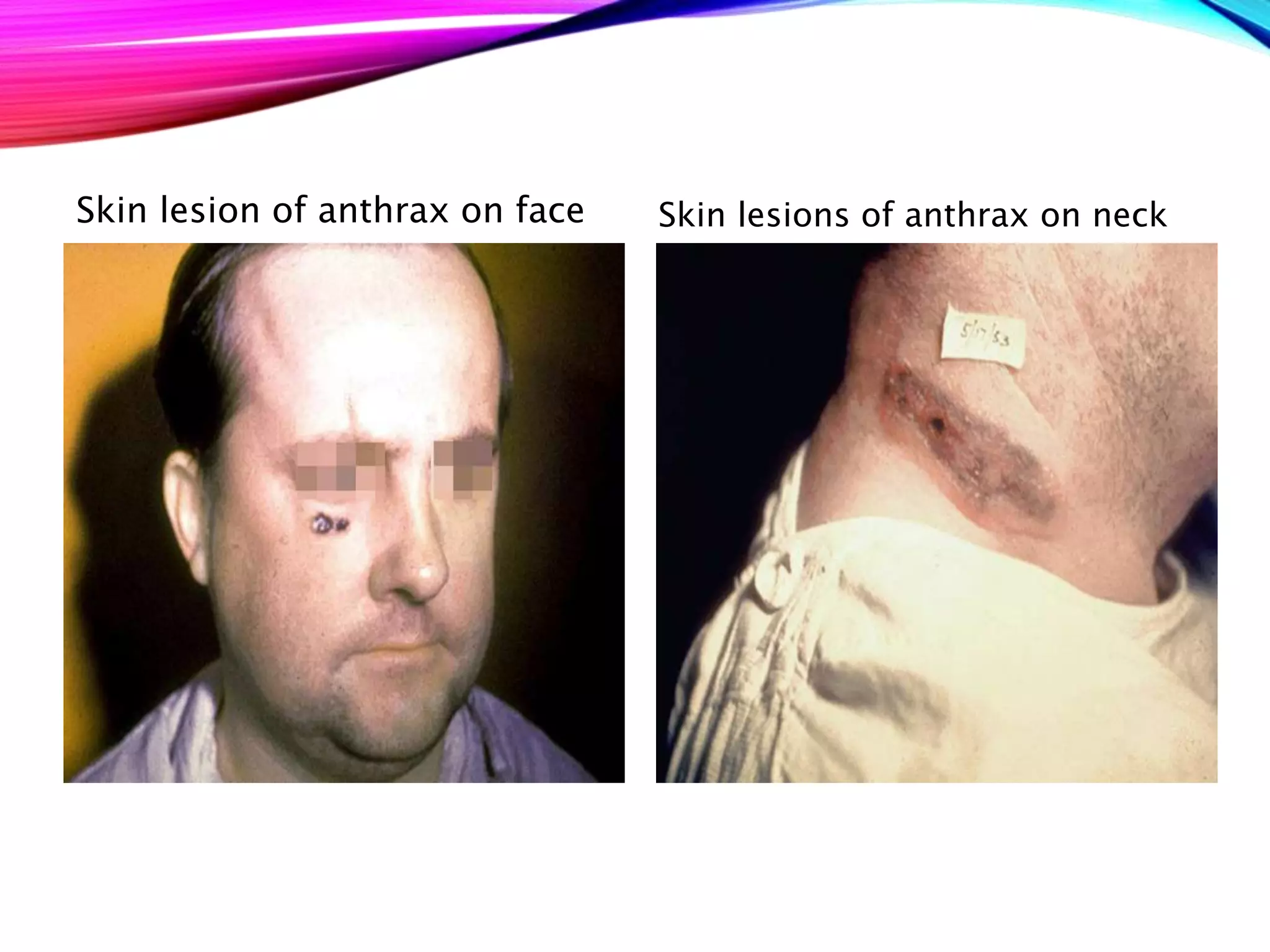 anthrax virus | PPTX