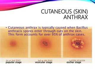 anthrax virus | PPTX
