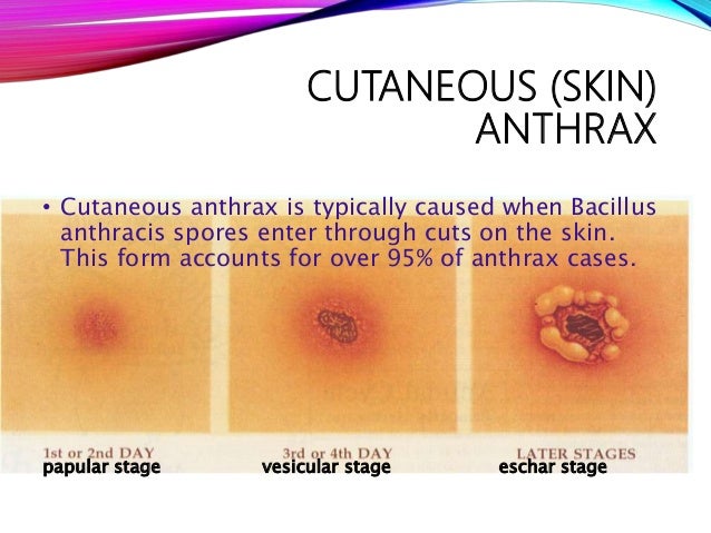 anthrax virus