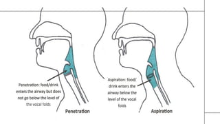Swallowing Function And Dysfunction, An Introduction To Oropharyngeal ...