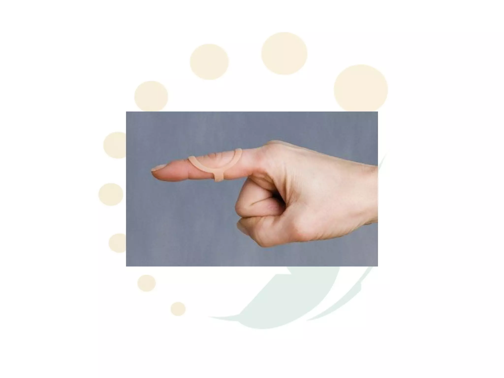Swan neck-deformity | PPT
