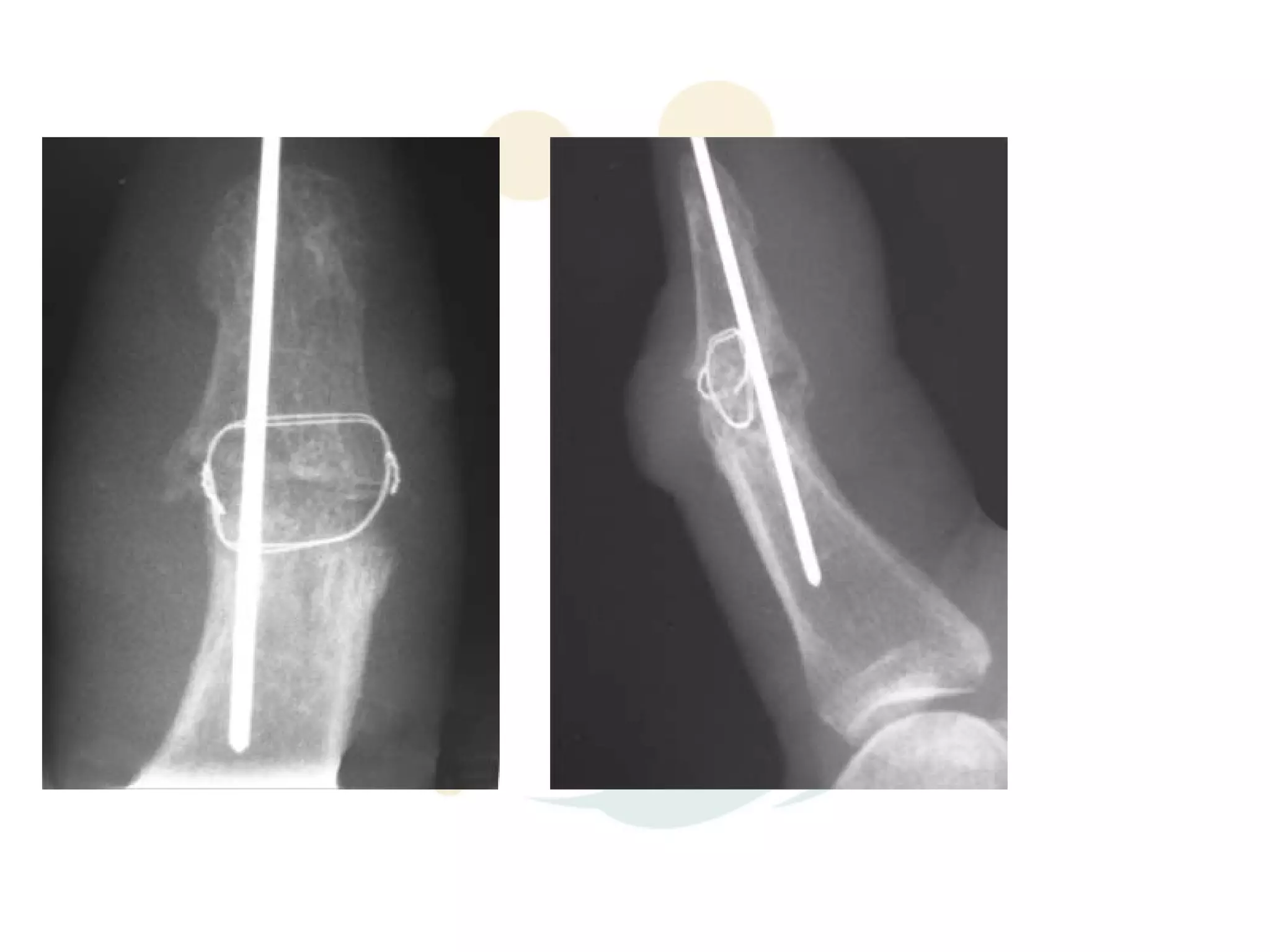 Swan neck-deformity | PPT