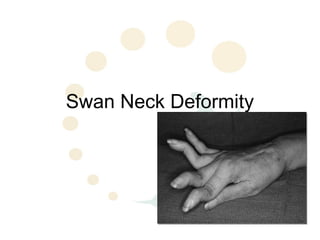 Swan neck-deformity | PPT
