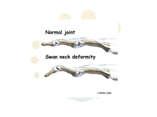 Swan neck-deformity | PPT