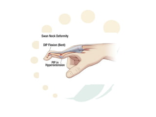 Swan neck-deformity | PPT
