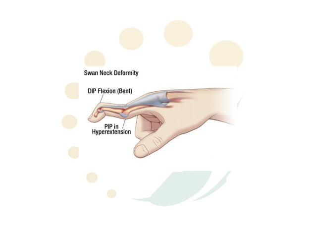 Swan neck-deformity | PPT | Death, Injury, or Military Conflict ...