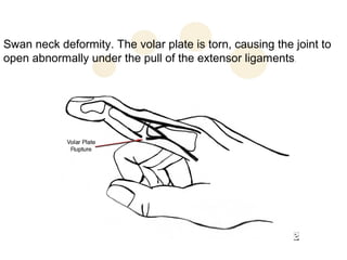 Swan neck-deformity | PPT