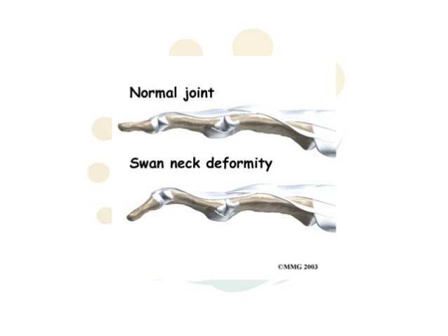 Swan neck-deformity