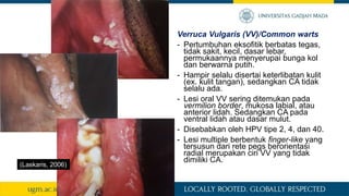 Oral Condyloma Acuminatum | PPTX