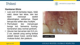 Oral Condyloma Acuminatum | PPTX