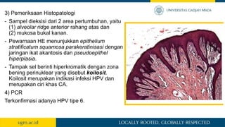 Oral Condyloma Acuminatum | PPTX