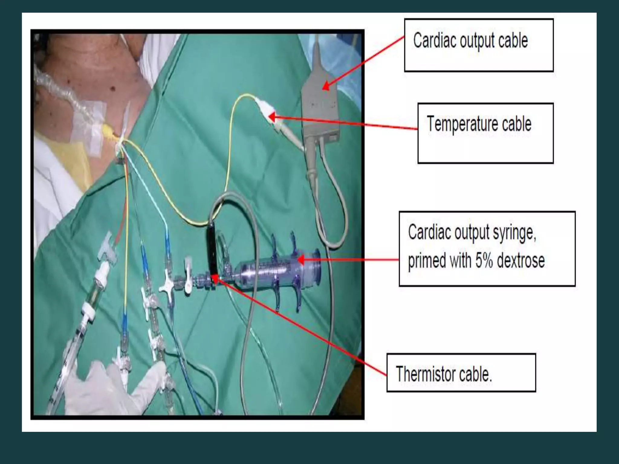 Pulmonary artery Catheter | PPT