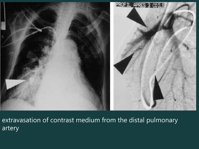 Pulmonary artery Catheter | PPT | Lung and Respiratory Health ...