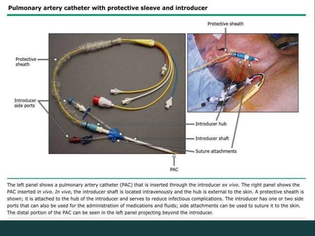 Pulmonary artery Catheter | PPT