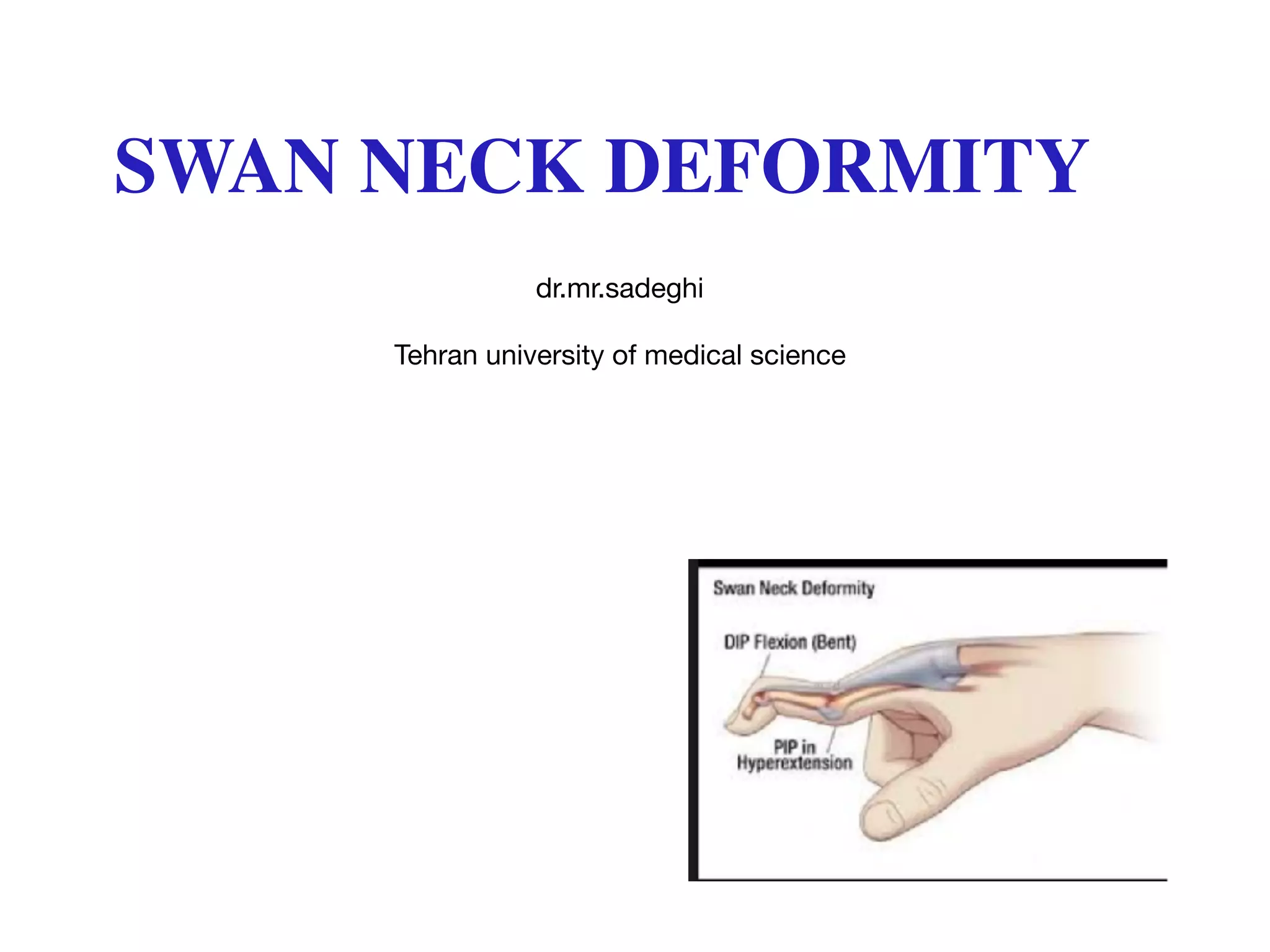 Swan Neck Deformity And Hand Surgery Ppt