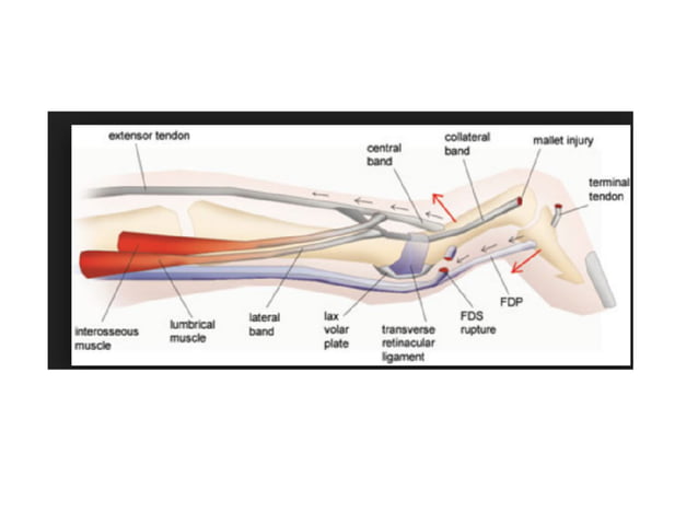 Swan Neck Deformity And Hand Surgery Ppt