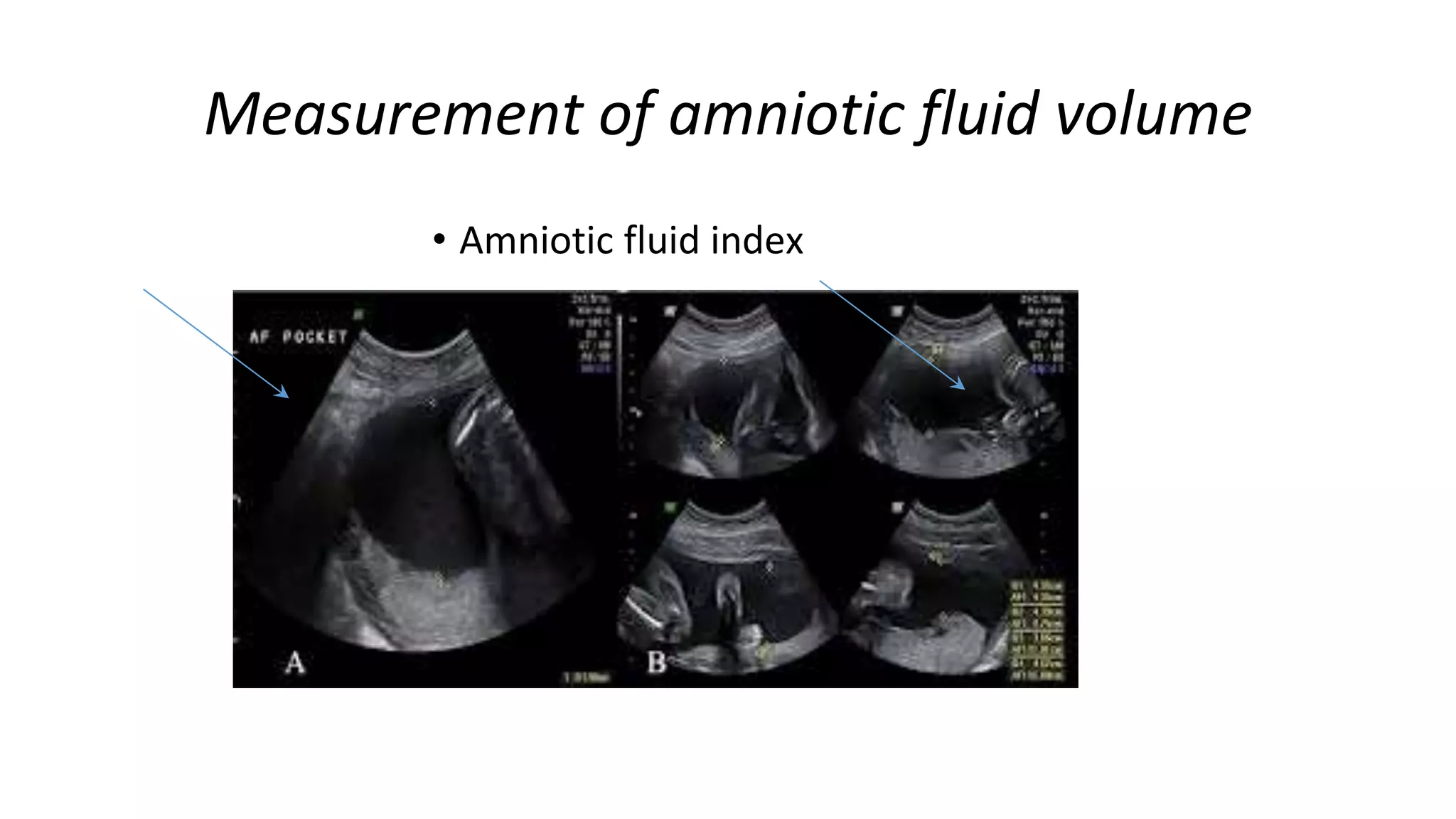 AMNIOTIC FLUID PPT | PPTX
