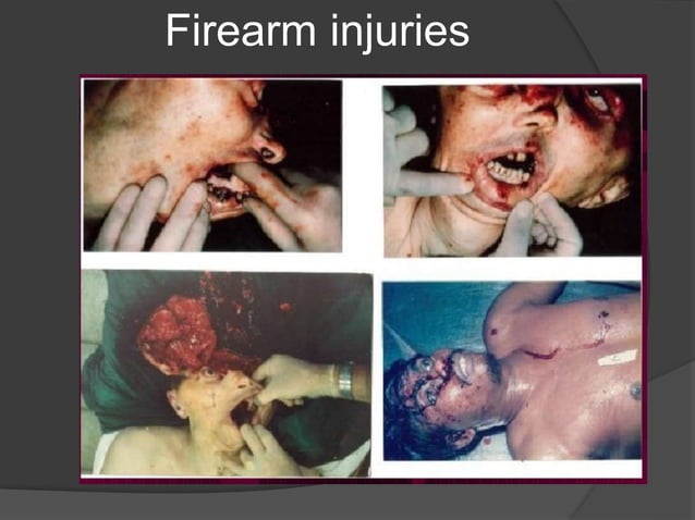 Firearm injuries | PPT