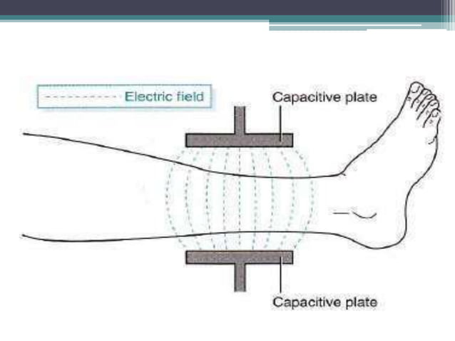 SHORT WAVE DIATHERMY (SWD) | PPTX | Physics | Science