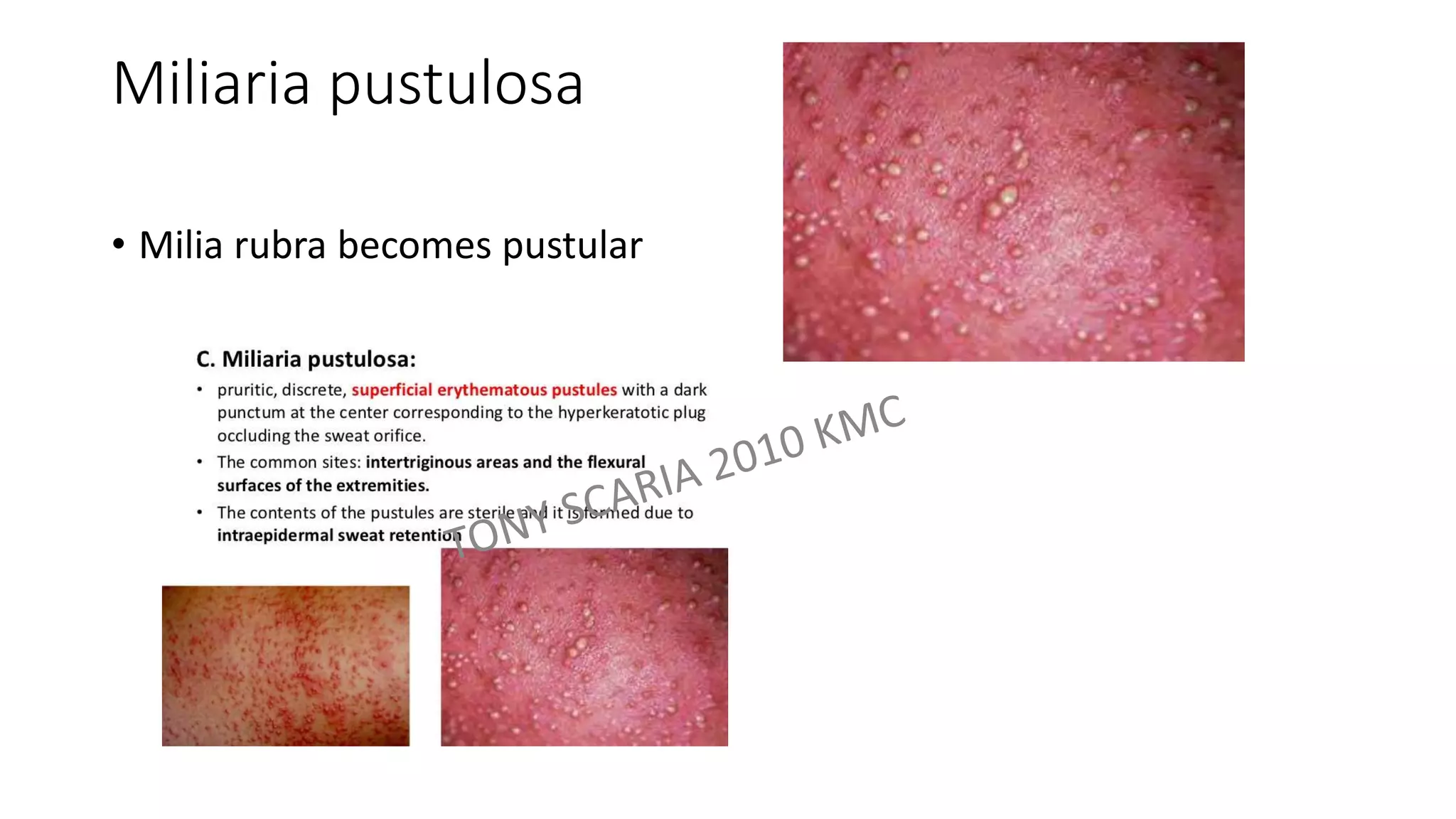 Sweat gland & sebaceous gland dermatology revision notes | PPTX