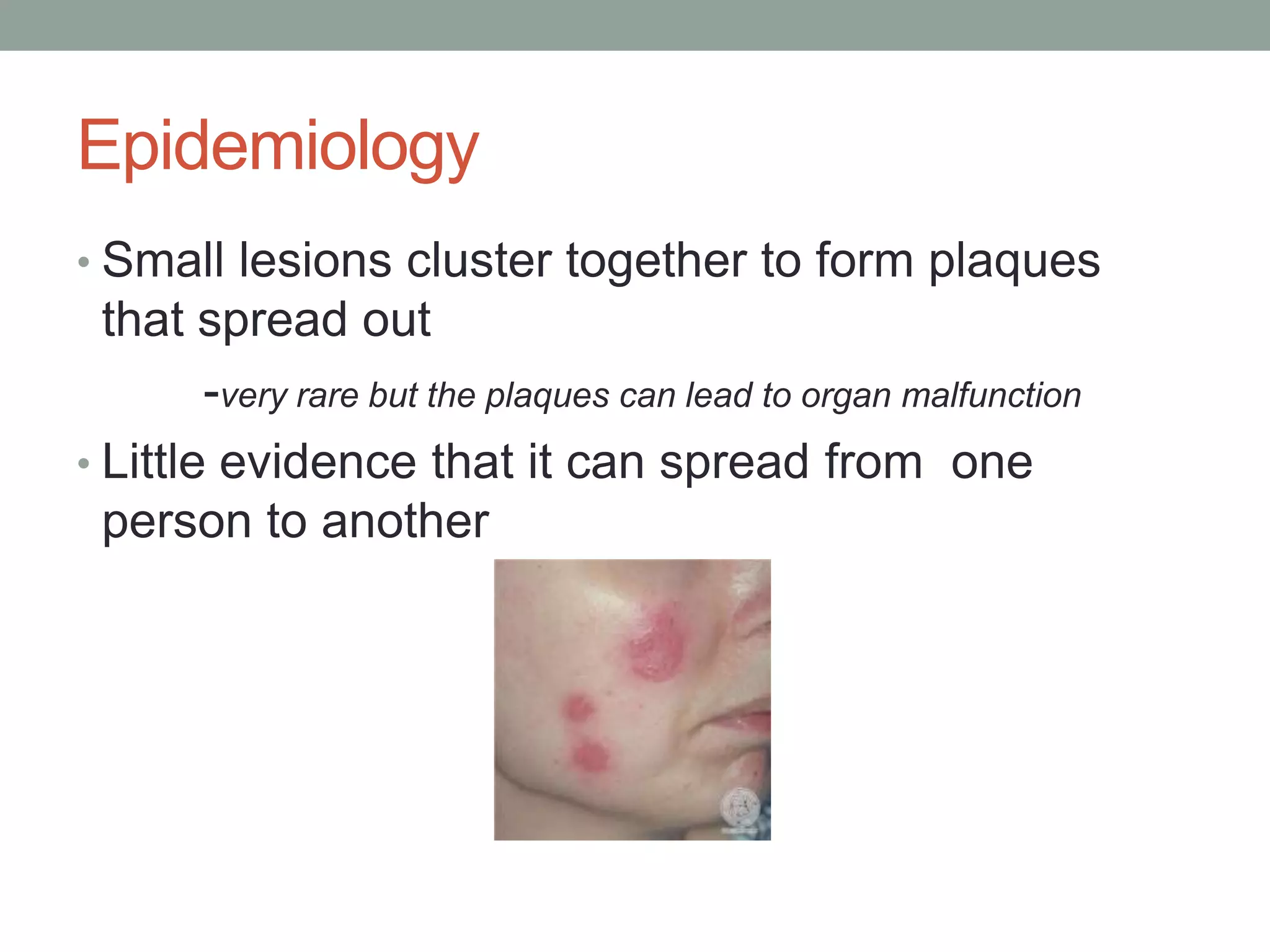 Sweet's syndrome | PPTX