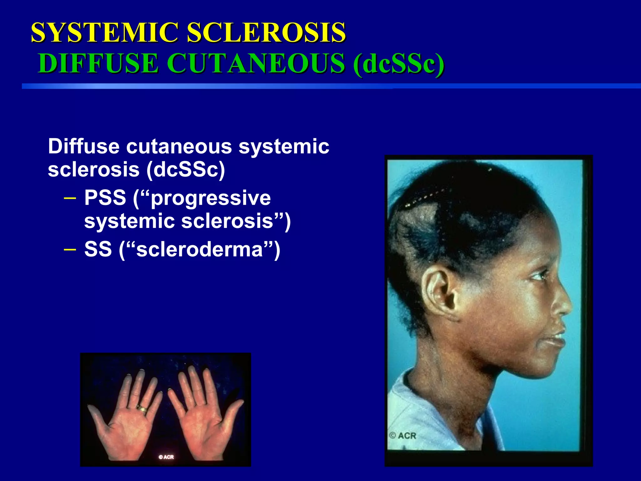 Overview of Scleroderma | PPT | Lung and Respiratory Health | Diseases and Conditions