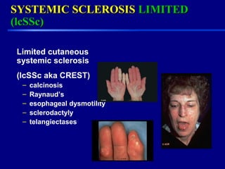 Overview of Scleroderma | PPT