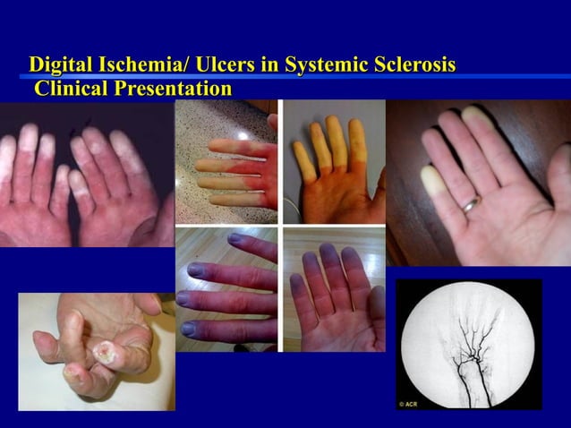 Overview of Scleroderma | PPT | Lung and Respiratory Health | Diseases ...