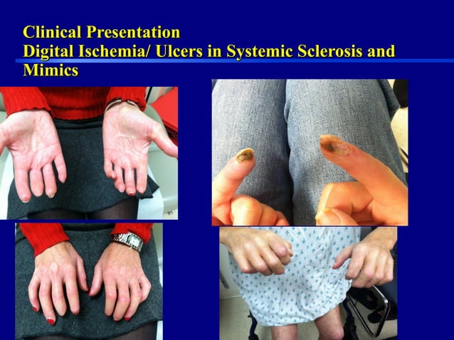 Overview of Scleroderma | PPT | Lung and Respiratory Health | Diseases ...