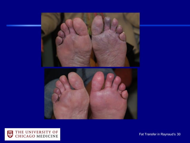 Overview of Scleroderma | PPT | Lung and Respiratory Health | Diseases ...