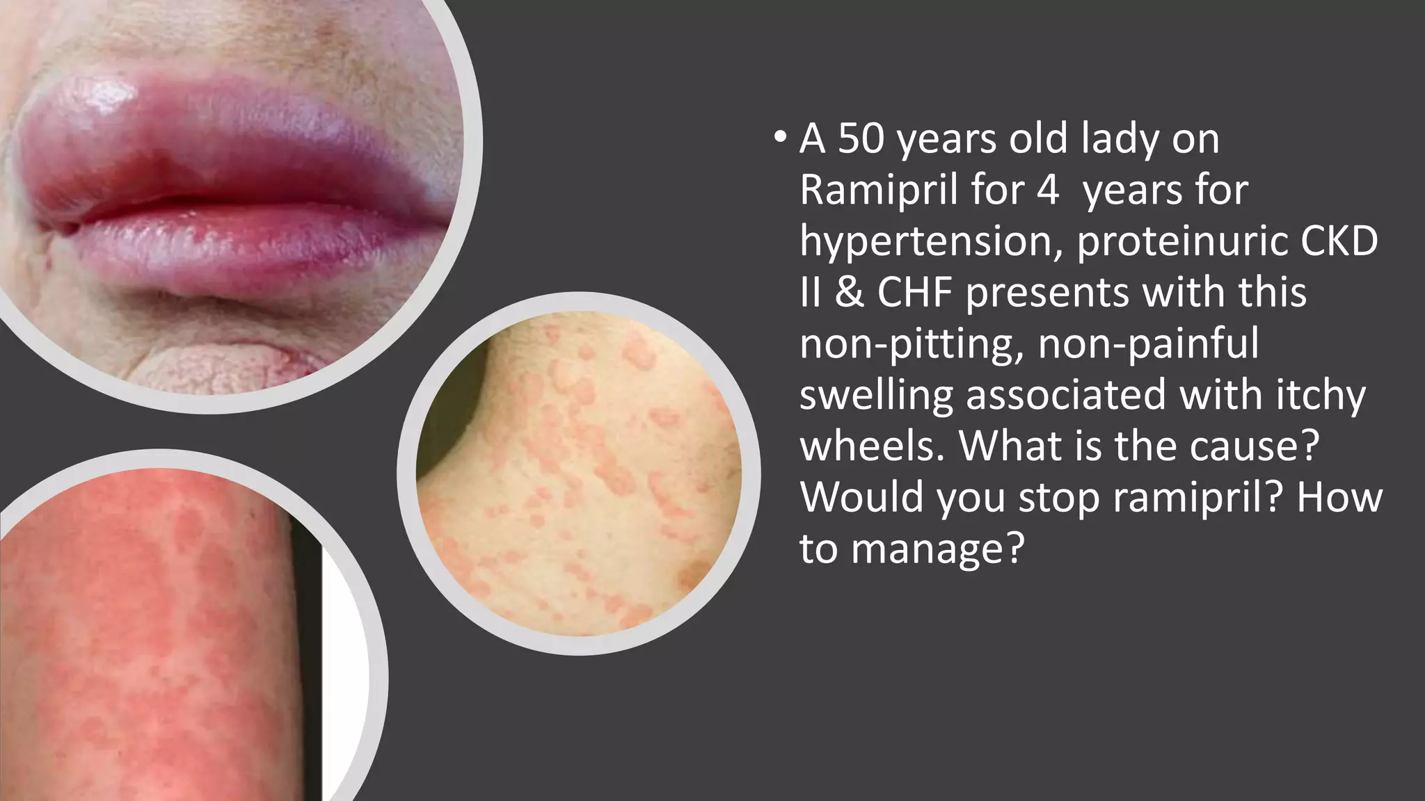 Swelling..swelling ( angioedema approach ) Ahmed Yehia, MD internal ...