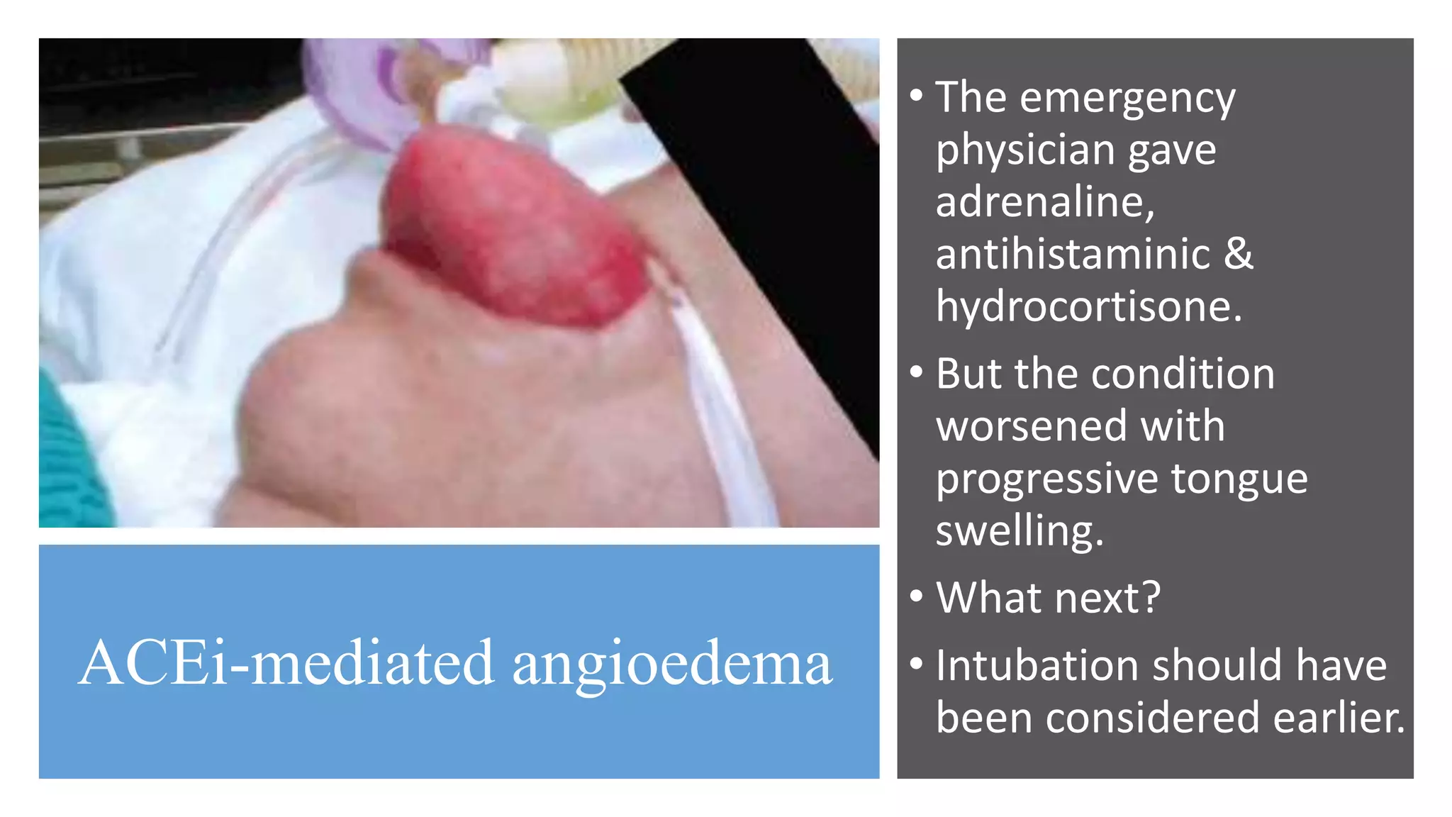 Swelling..swelling ( angioedema approach ) Ahmed Yehia, MD internal ...