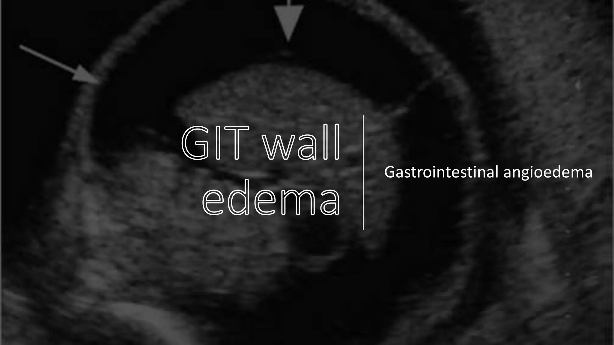 Swelling..swelling ( angioedema approach ) Ahmed Yehia, MD internal ...