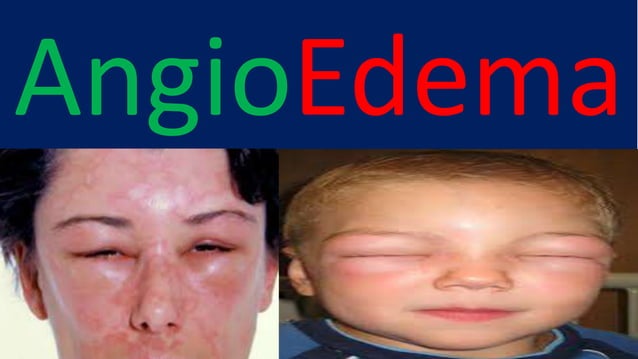 Swelling..swelling ( angioedema approach ) Ahmed Yehia, MD internal ...