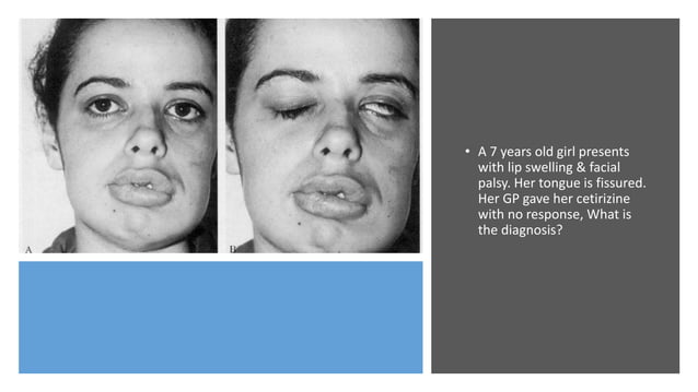 Swelling..swelling ( angioedema approach ) Ahmed Yehia, MD internal ...