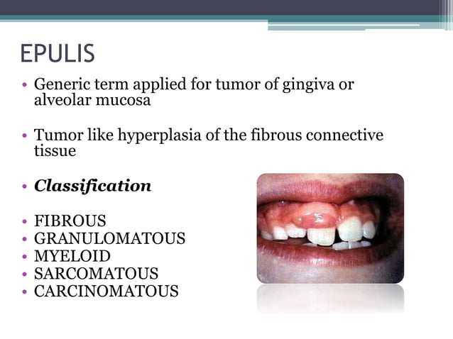 Swellings of the jaw | PPTX | Dental Health | Diseases and Conditions