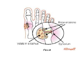 Gout | PPT