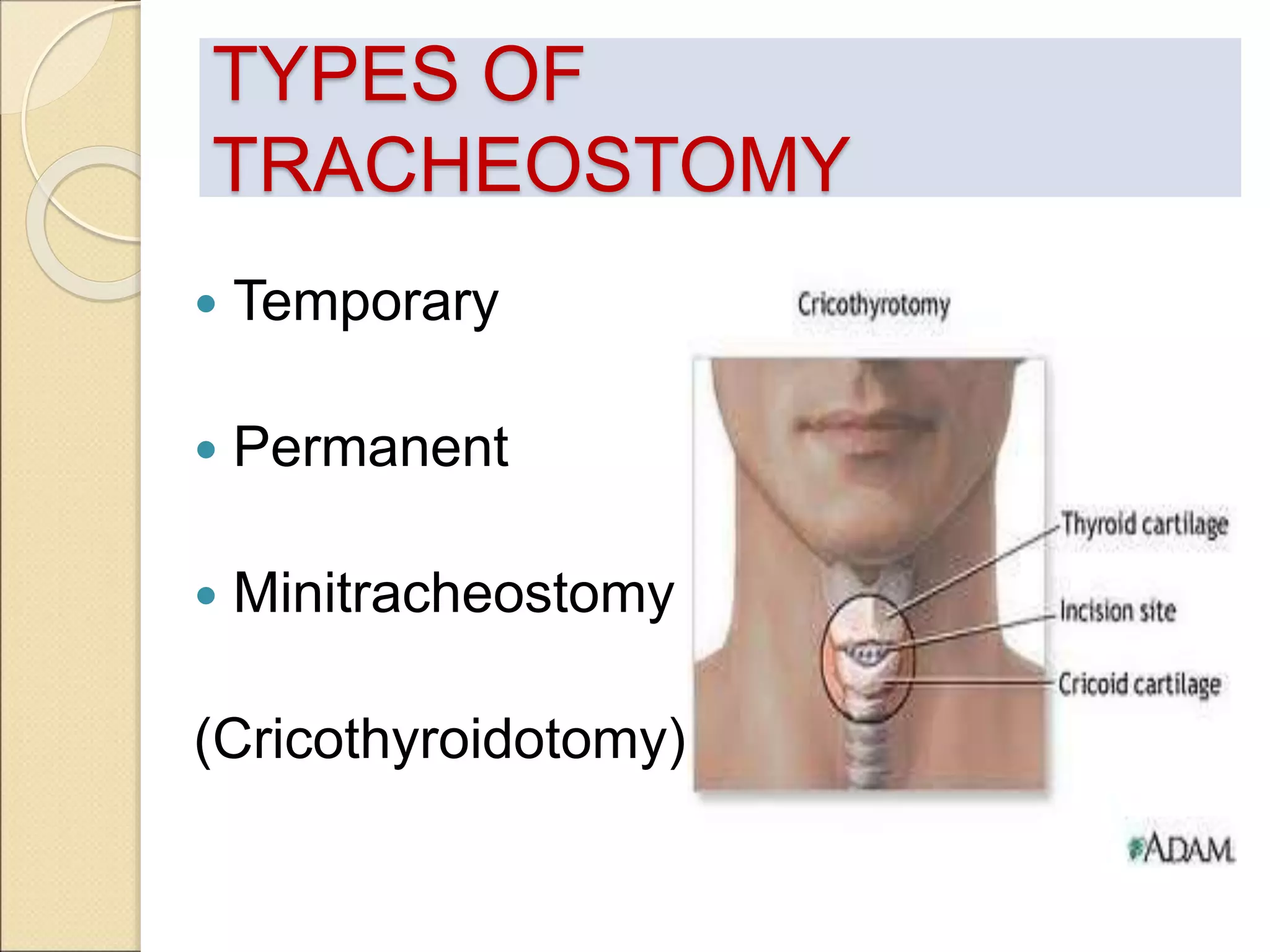 Tracheostomy | PPT