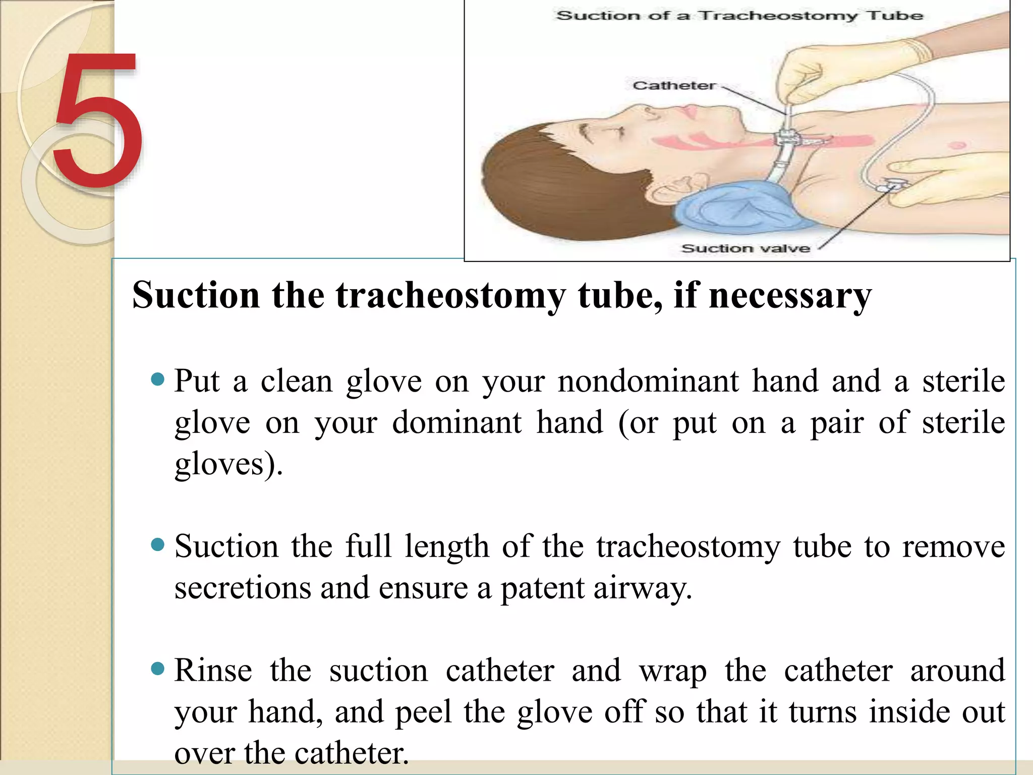 Tracheostomy | PPT
