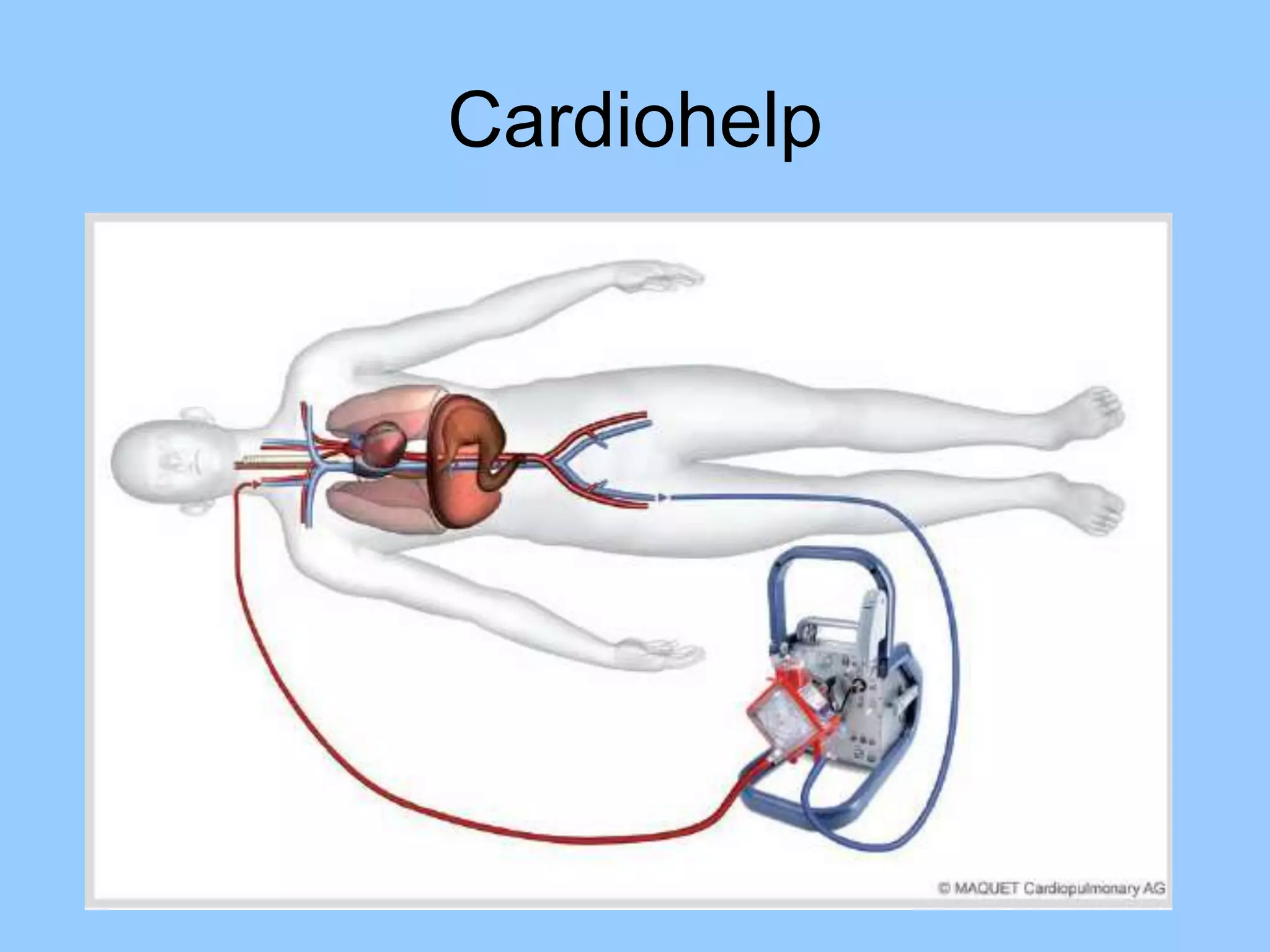 VV-ECMO - indications and concerns | PPTX