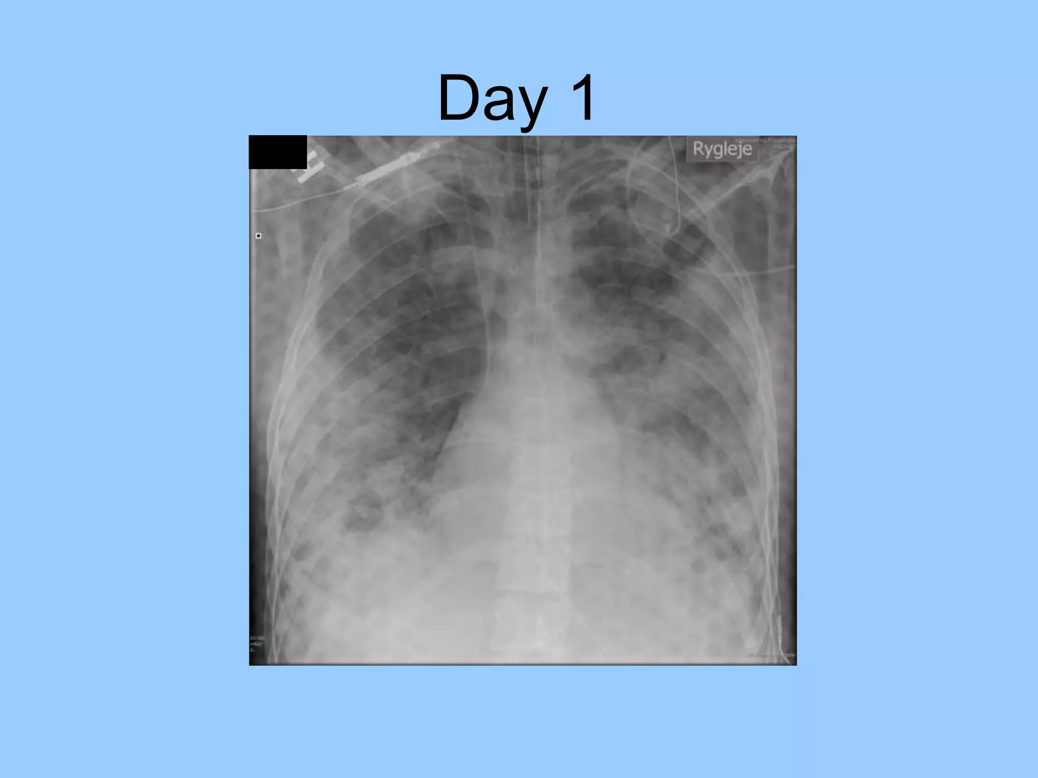 VV-ECMO - indications and concerns | PPTX