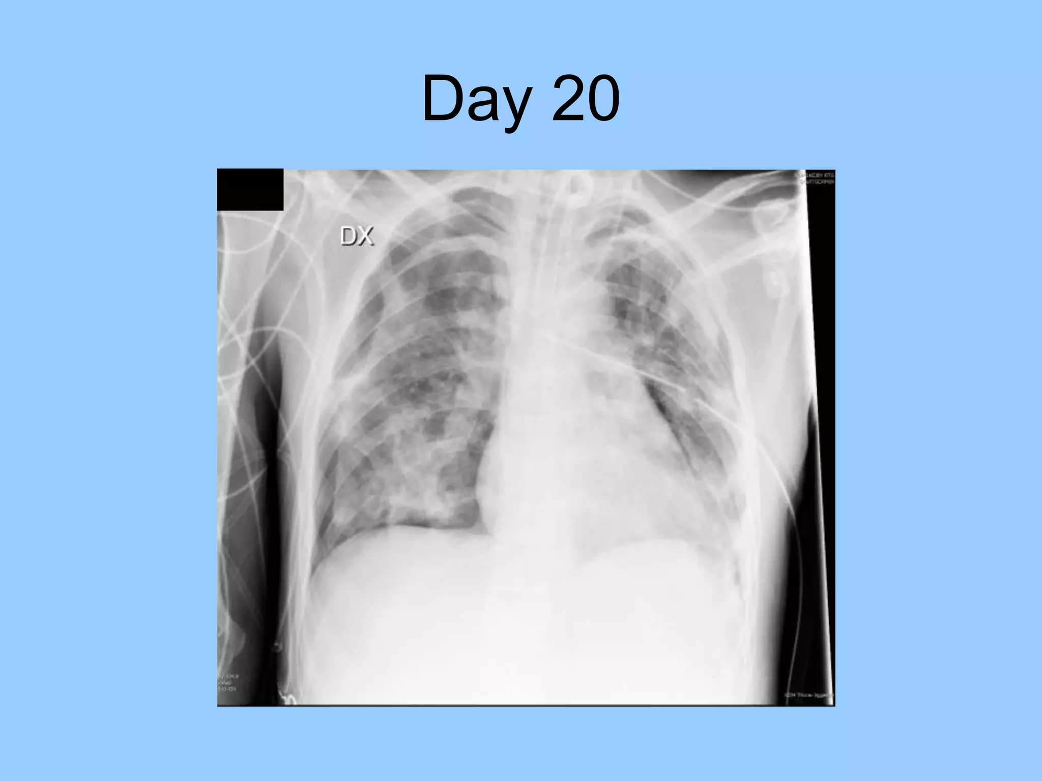 VV-ECMO - indications and concerns | PPTX