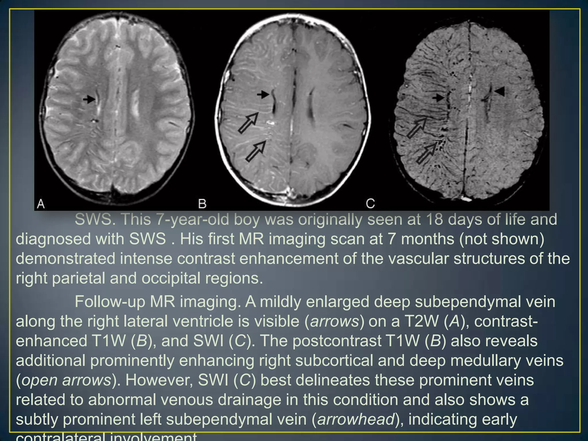 Susceptibility Weighted Imaging (SWI) | PPTX