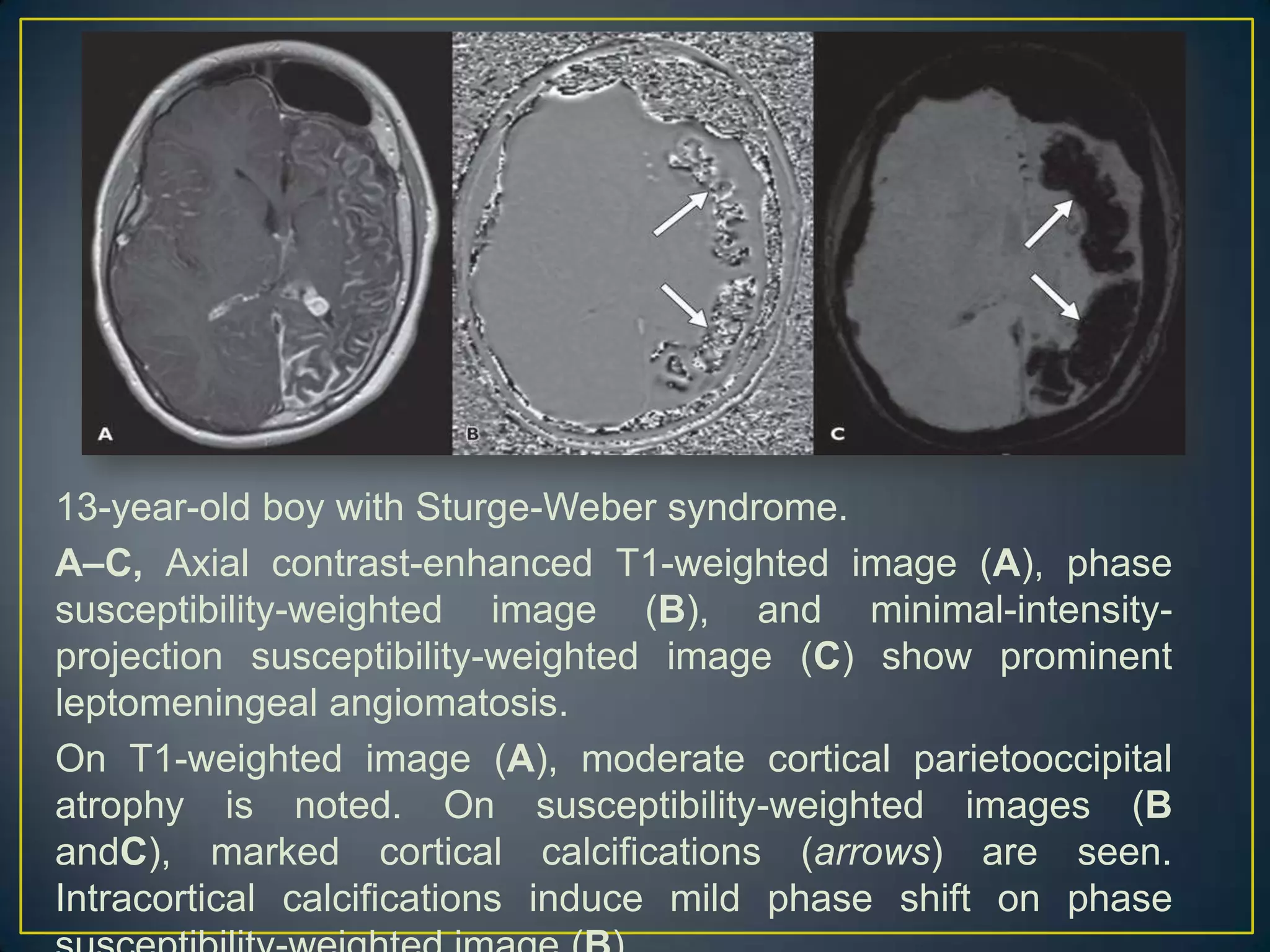 Susceptibility Weighted Imaging (SWI) | PPTX