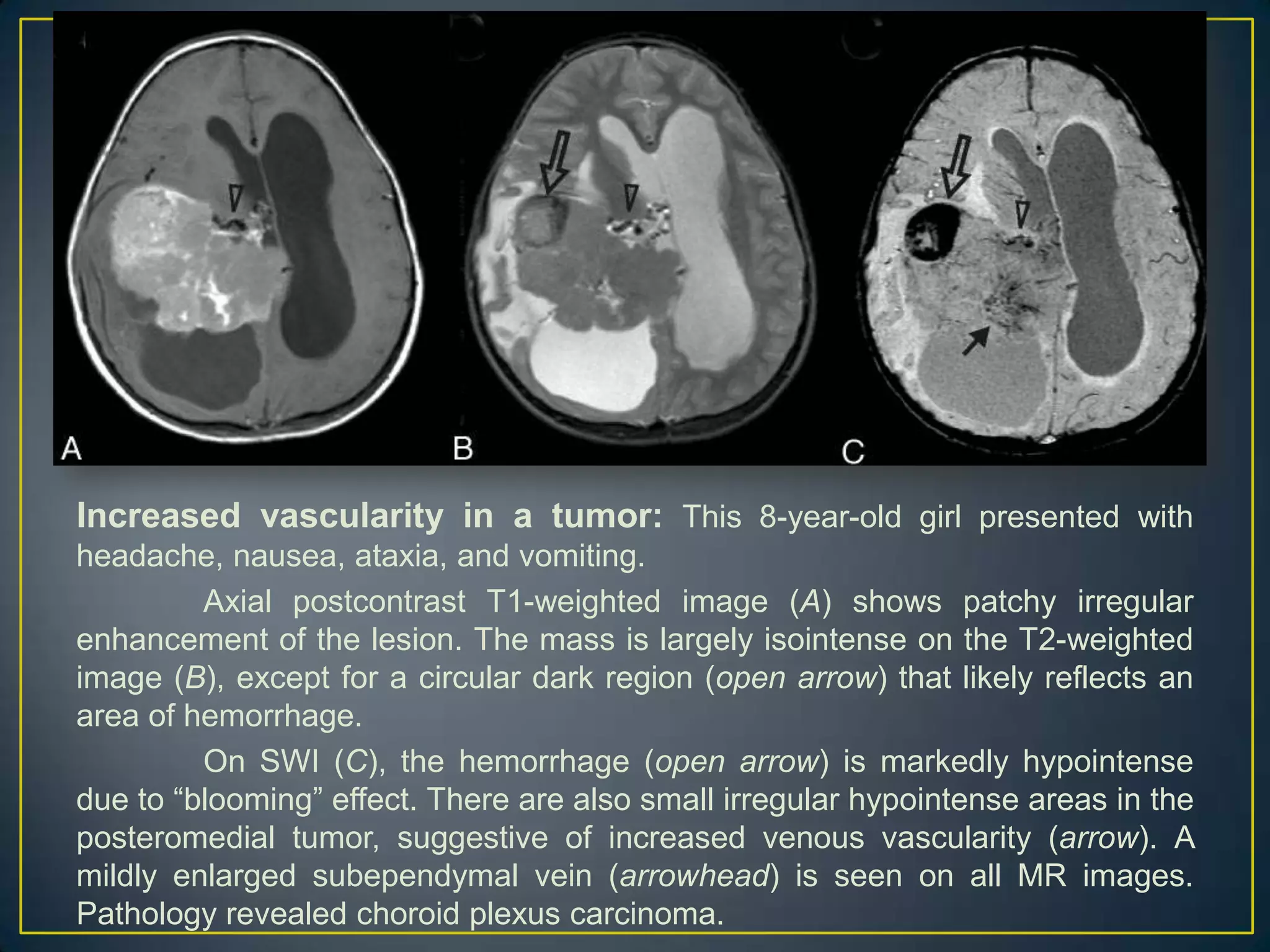 Susceptibility Weighted Imaging (SWI) | PPTX